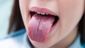 Glositis: ¿Qué es y qué la causa? | Clínicas Dentales CDMX